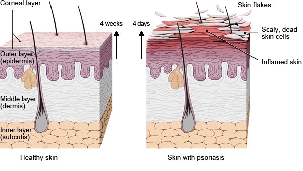 Psoriasis | informedhealth.org